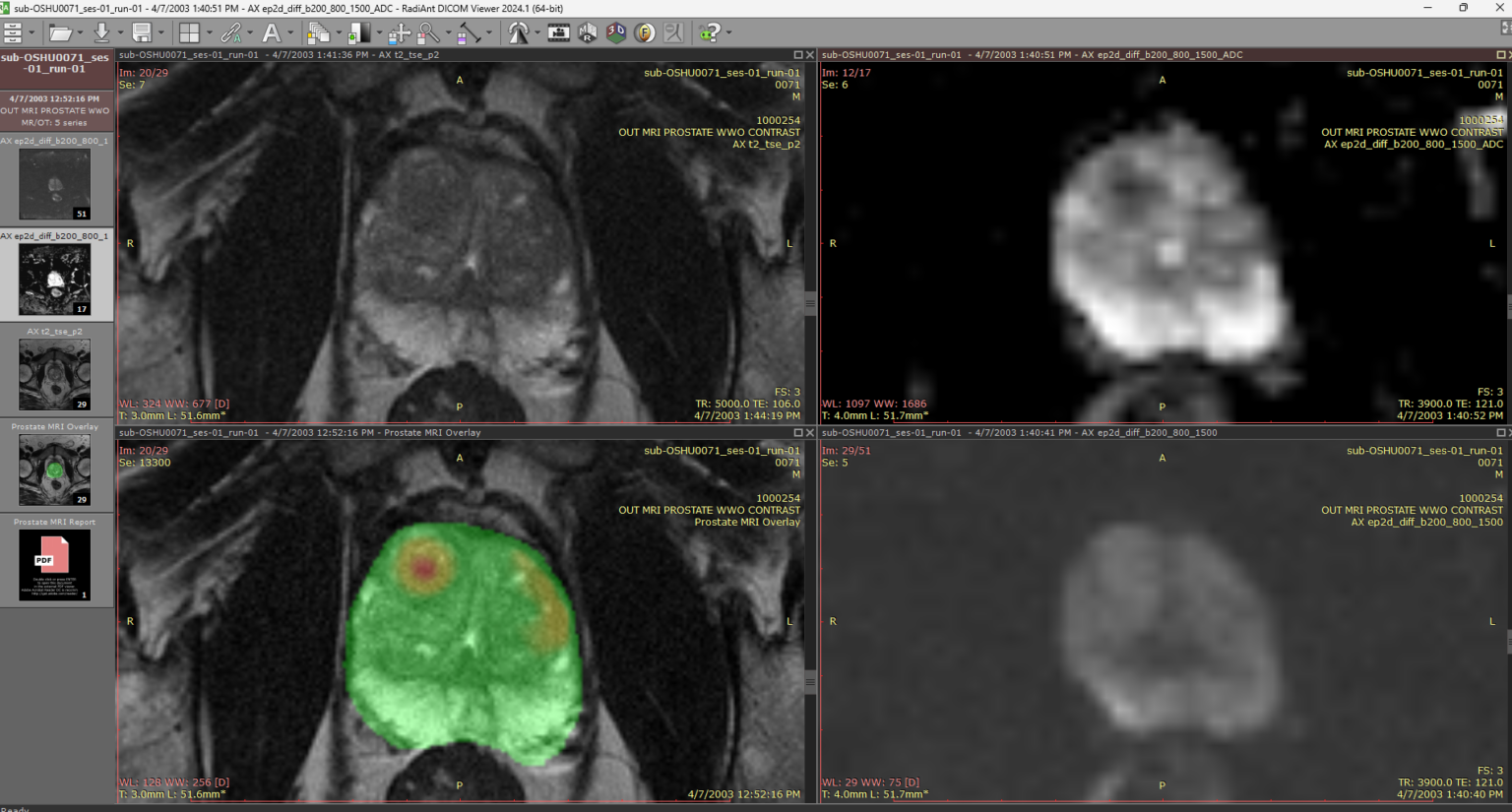 Prostate Cancer Detection with AI | Prostate Cancer Diagnosis with AI