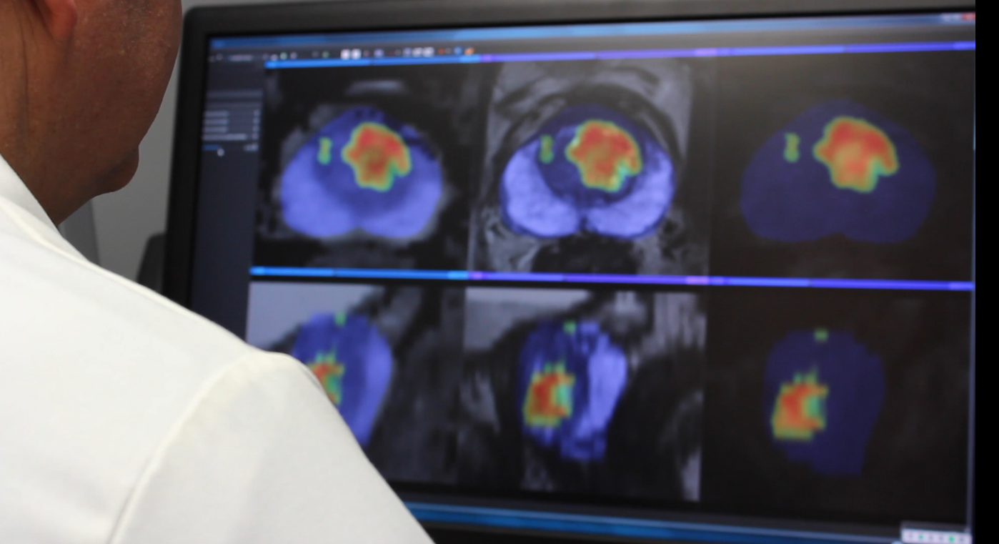 Prostate Cancer Detection with AI | Prostate Cancer Diagnosis with AI
