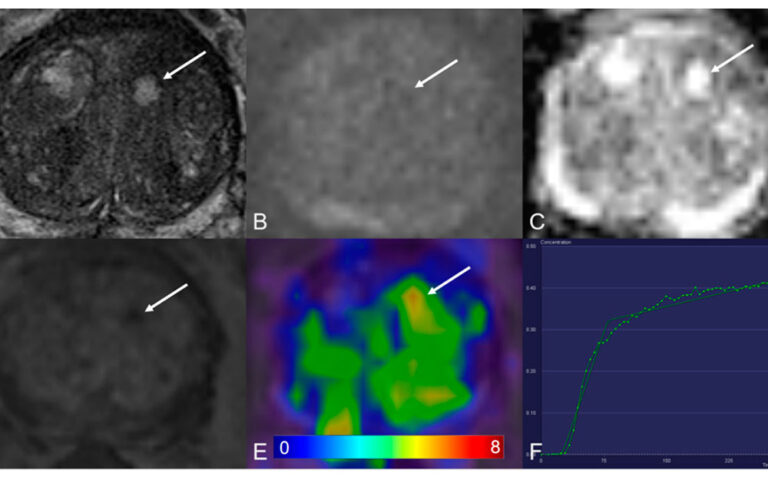 DCE MRI in Prostate Cancer: Contrast Kinetics Explained