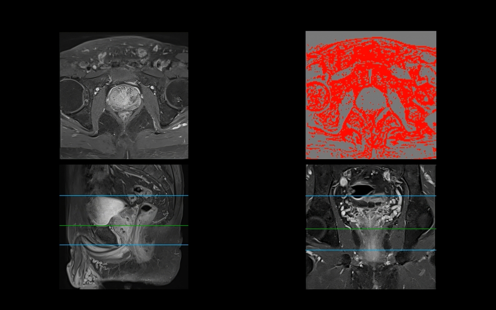 DWI and ADC in Prostate Cancer MRI Classification